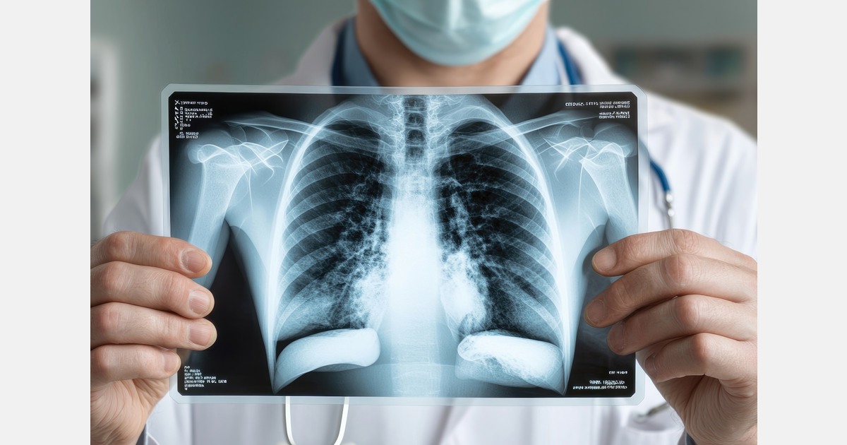 Tweede geval van besmettelijke tbc ontdekt bij Maître